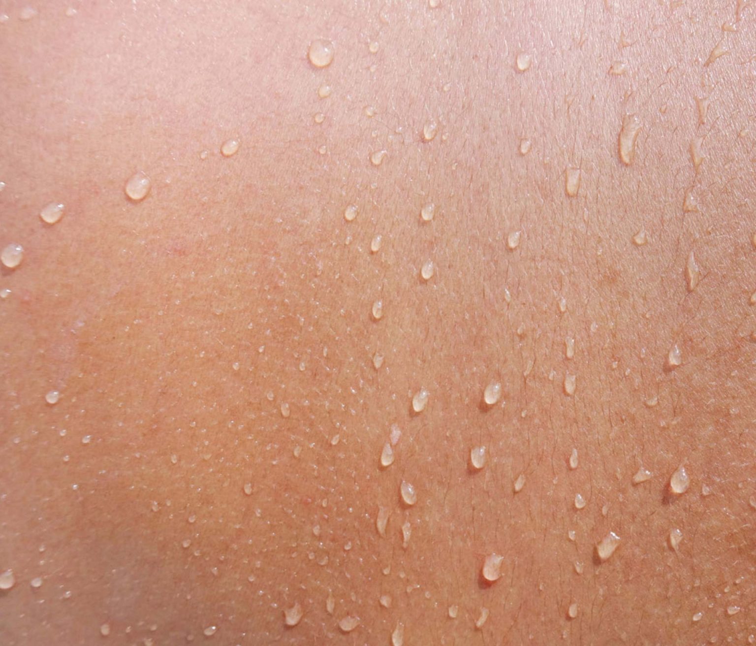 Hyperhidrosis - Canterbury Dermatology & Laser Clinic